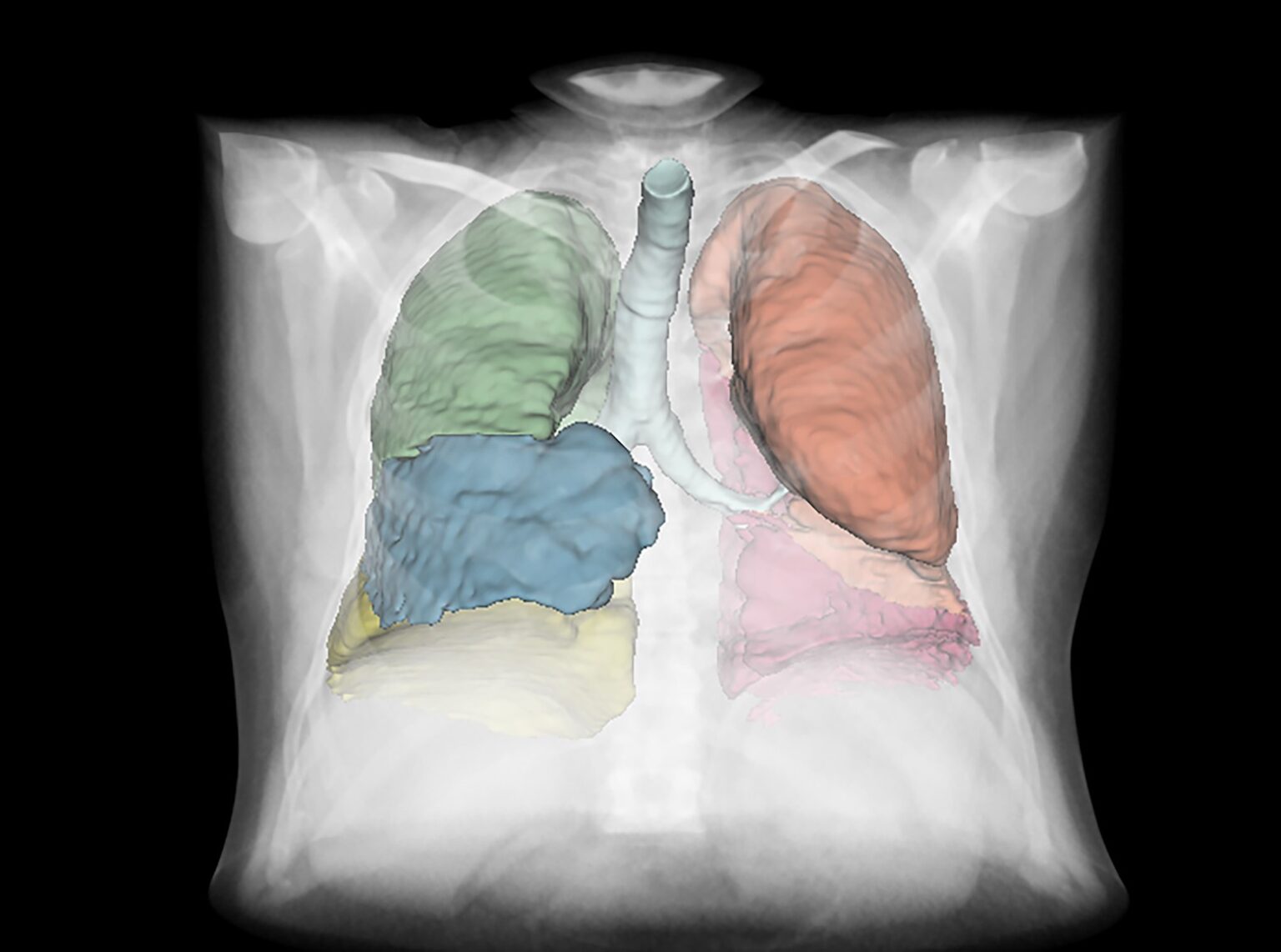 Qureight Announces World’s First Digital Biomarker for Lung Fibrosis