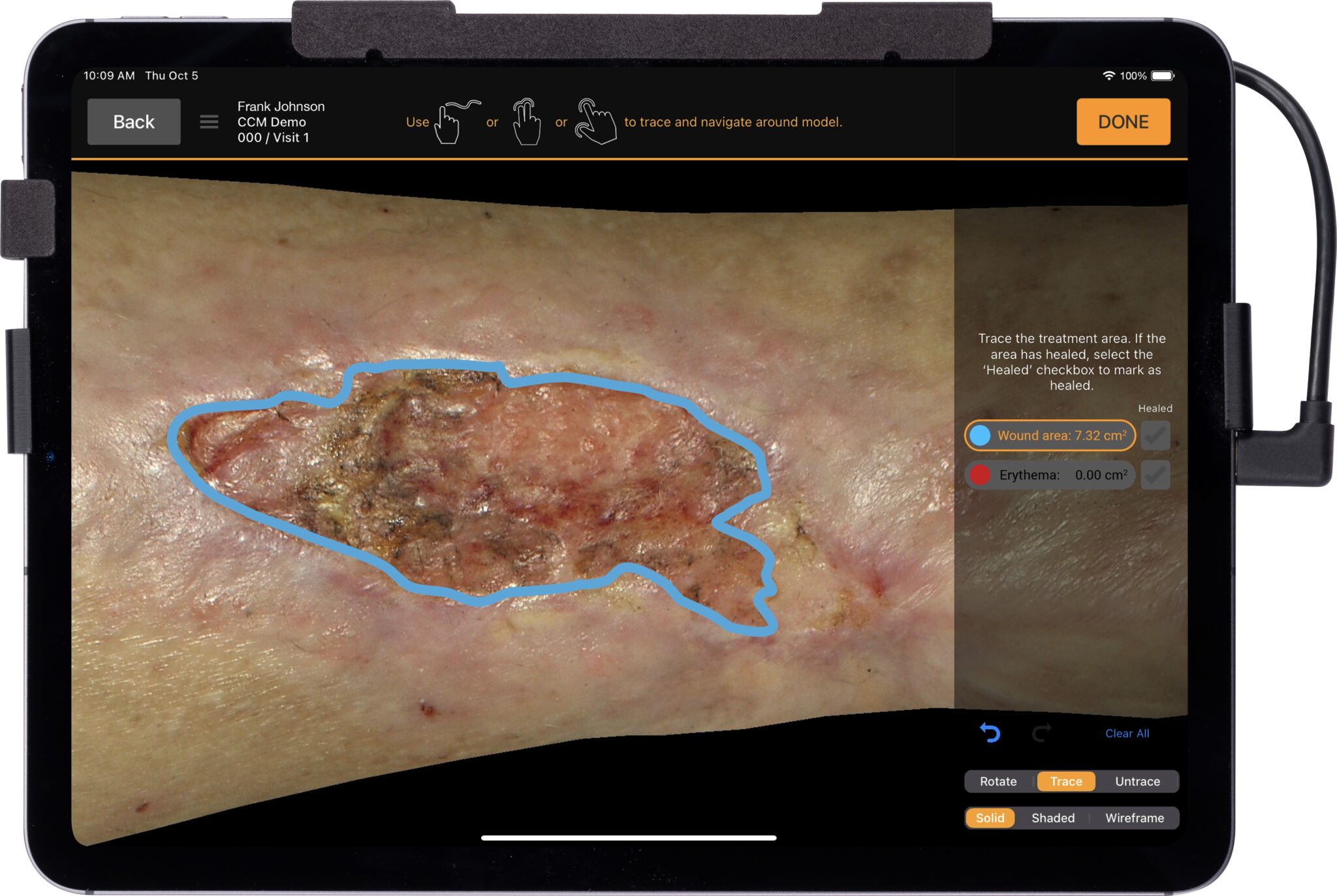 BirchBioMed Announces Hamilton Health Sciences’ Centre for Burn ...